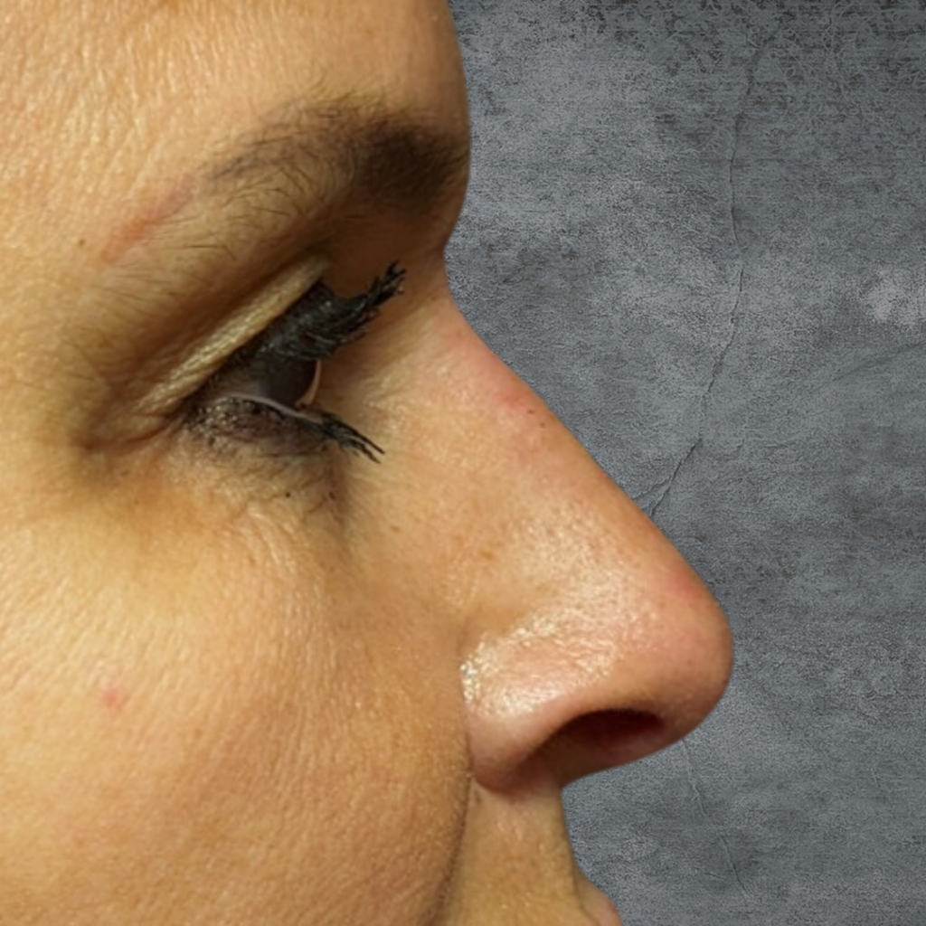 Non-Surgical Rhinoplasty In Baltimore, Maryland | Prime Facial